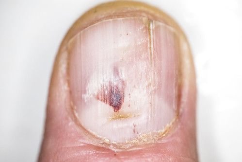 Learn How To Cure Your Fungus/Yeast Infection With Garlic